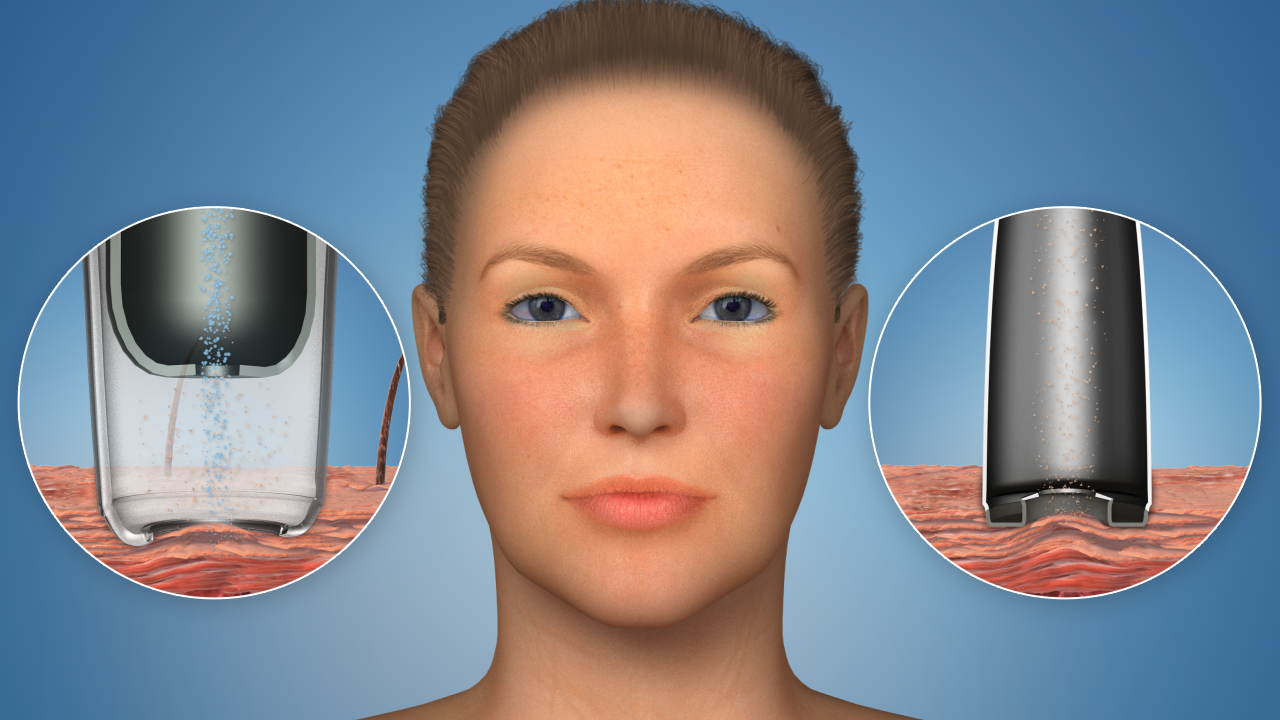 About the types & benefits of microdermabrasion machine for spa, here ...